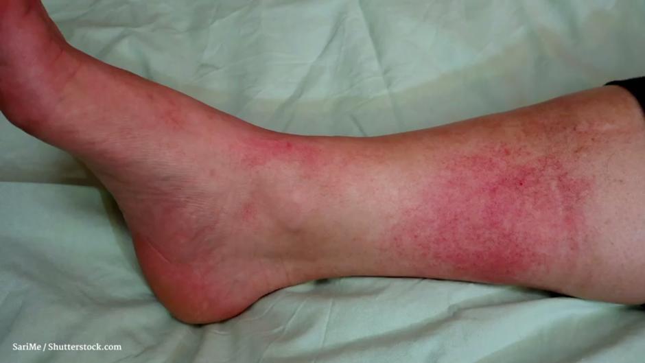 Gesundheitslexikon: Erysipel (Wundrose)