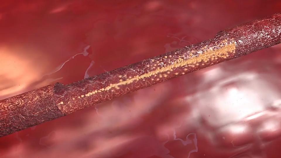 Gesundheitslexikon: Fisteln