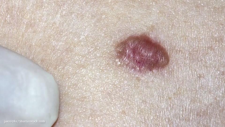 Gesundheitslexikon: Basaliom (Basalzellkarzinom, Heller Hautkrebs ...