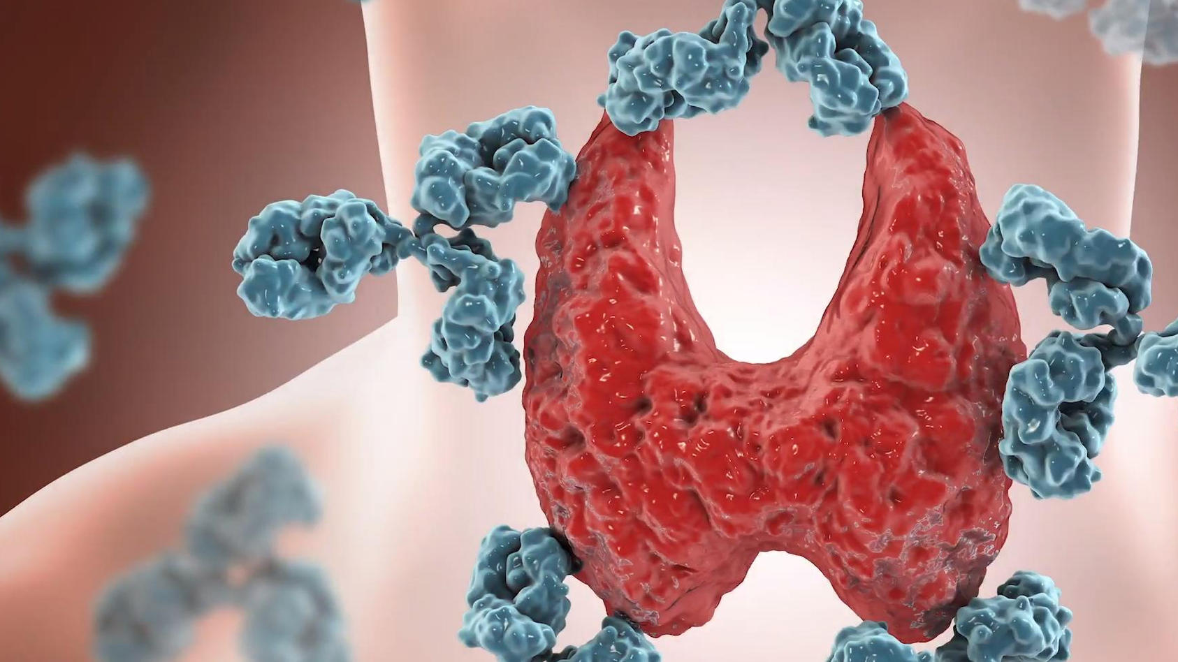 Gesundheitslexikon: Hashimoto-Thyreoiditis (autoimmune ...