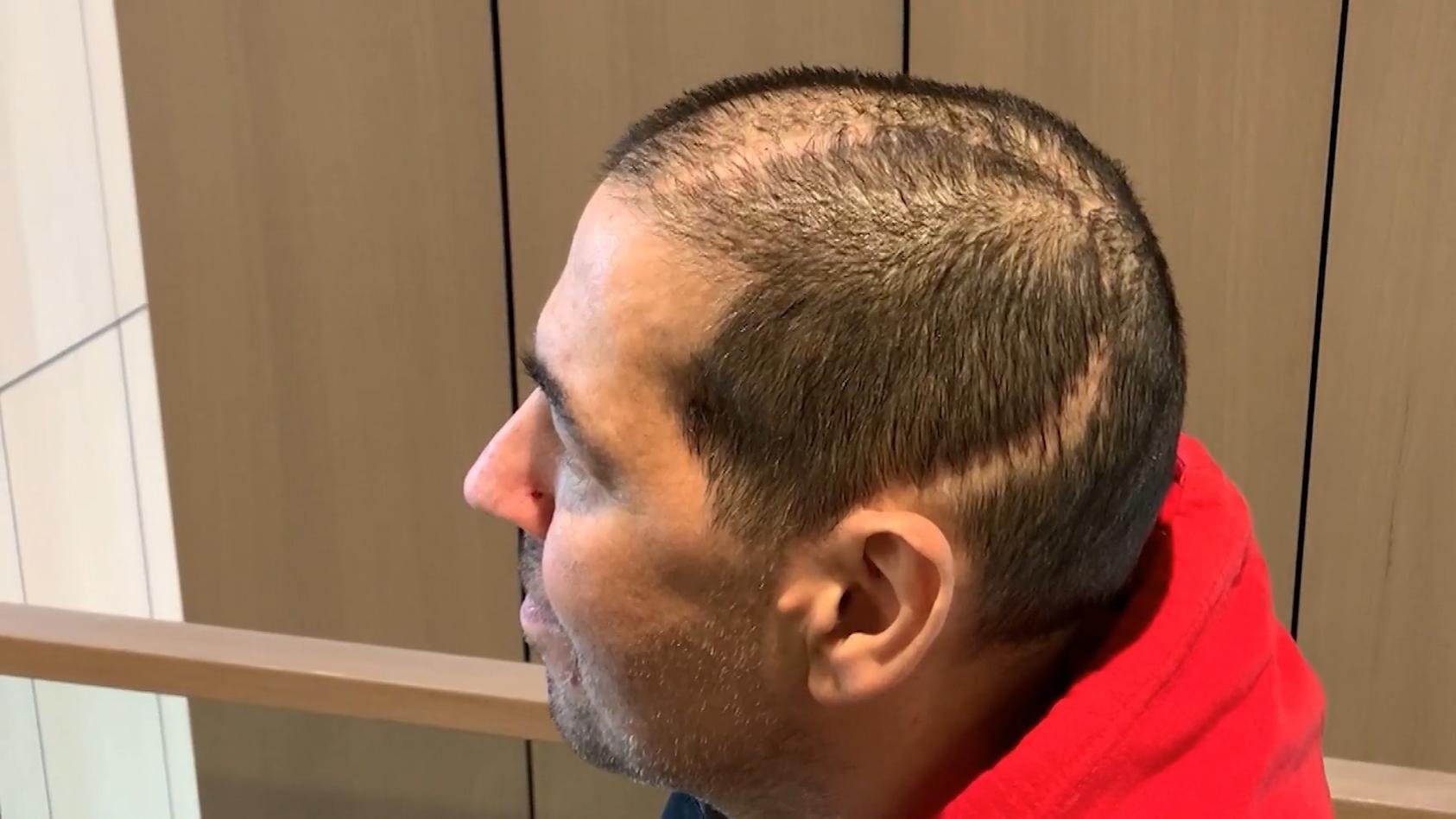 Prozess um Loch im Kopf