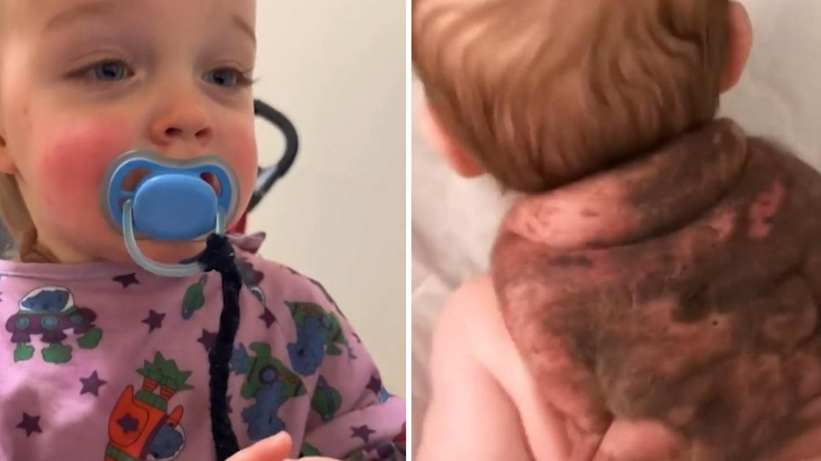Vermeintliches Muttermal wächst und wächst - Baby James trägt ...