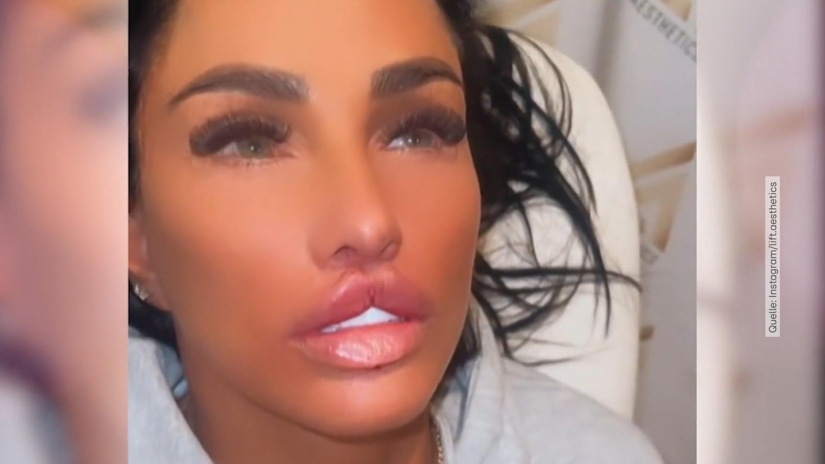 Katie Price hat nach Beauty-Eingriff eine gespaltene Lippe